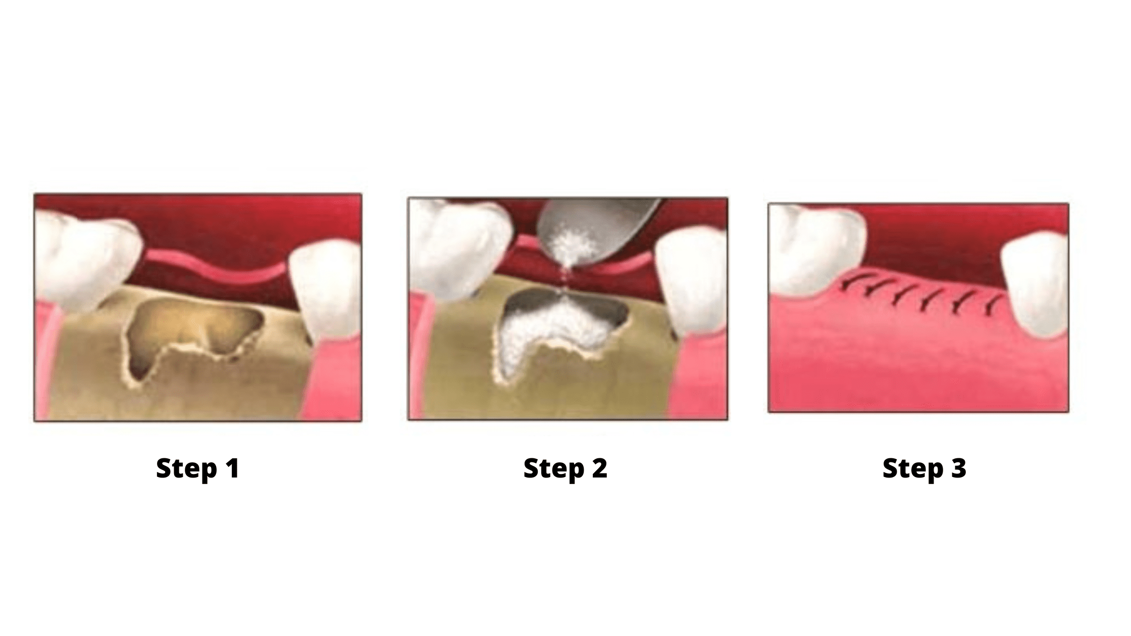 Bone Graft After Tooth Extraction Techniques Alternatives Healing Bone Graft After Tooth Extraction Techniques Alternatives Healing