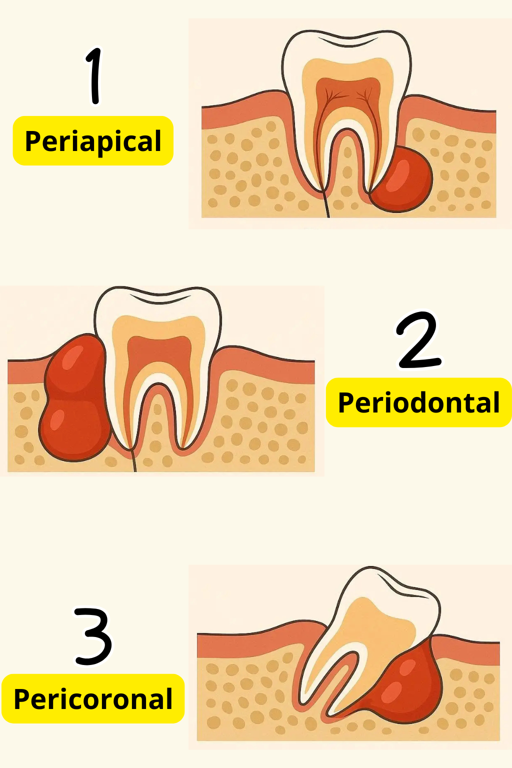 How Can Various Dental Infections and Abscesses Affect You?