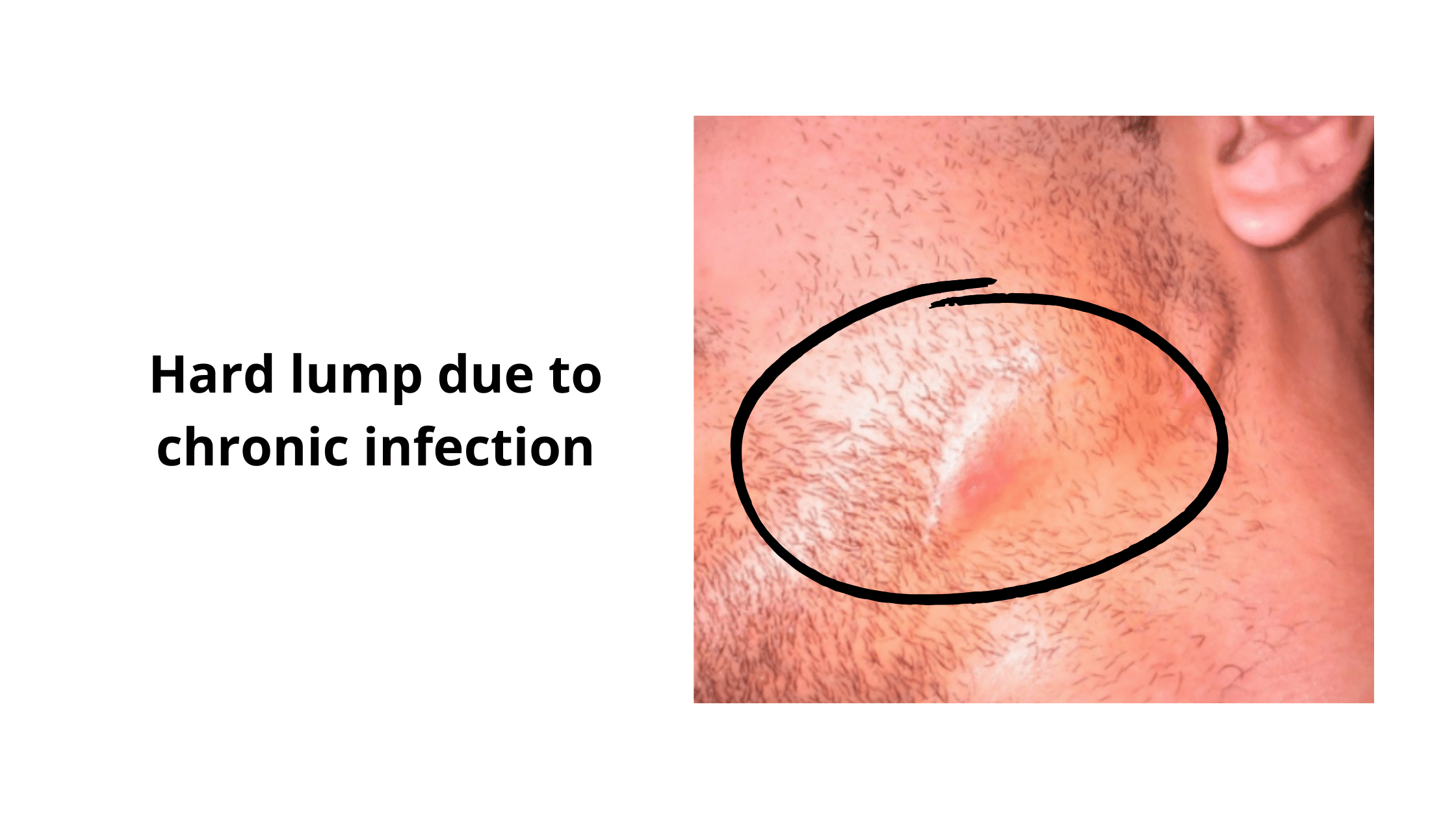 Hard Lump On Jawbone Under Skin After Wisdom Teeth Removal Infoupdate Hard Lump On Jawbone Under Skin After Wisdom Teeth Removal Infoupdate