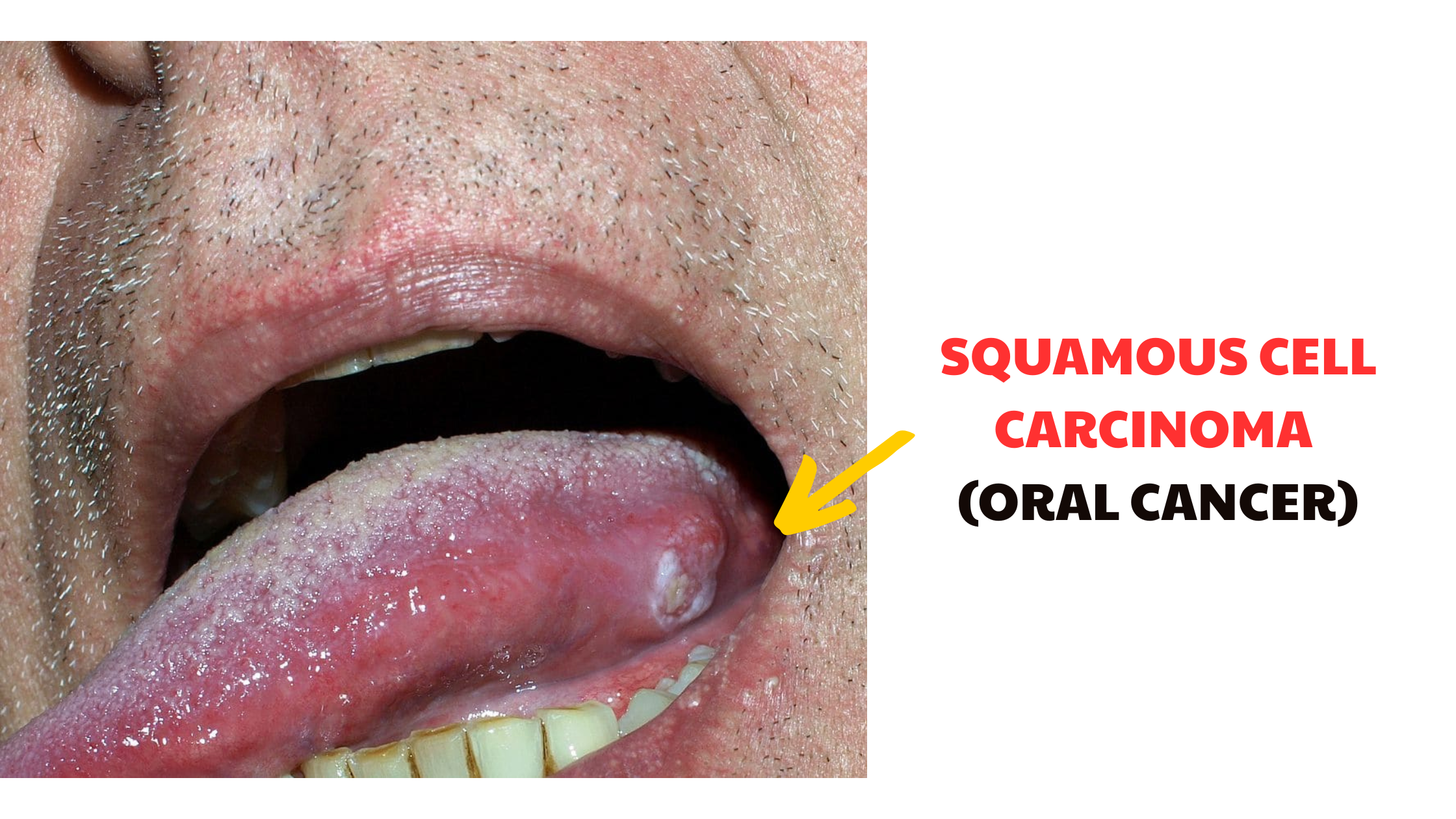 Tongue Cancer