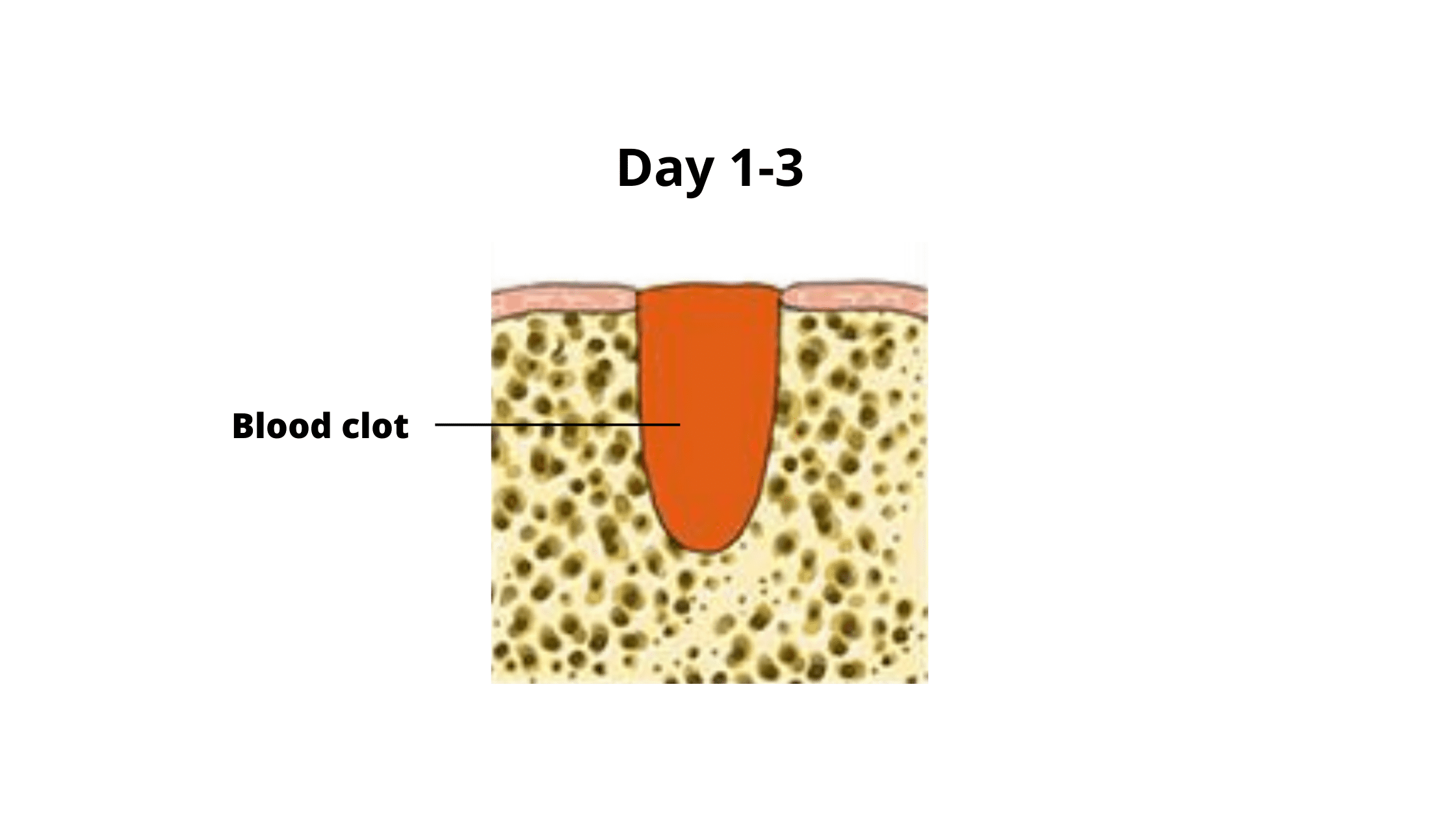 Wisdom Teeth Healing Process Pictures